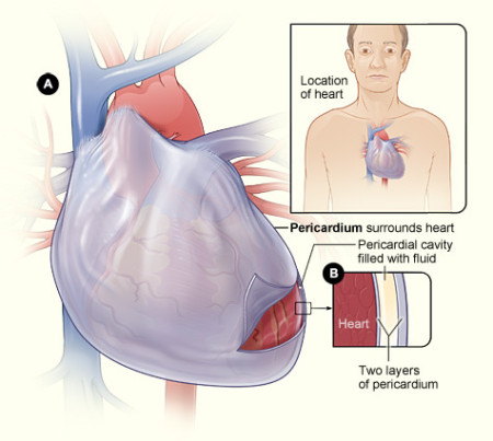 Pericarditis - Heart & Health Medical PLLC
