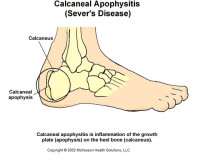 calcaneal-apophysitis | Heart and Health Medical