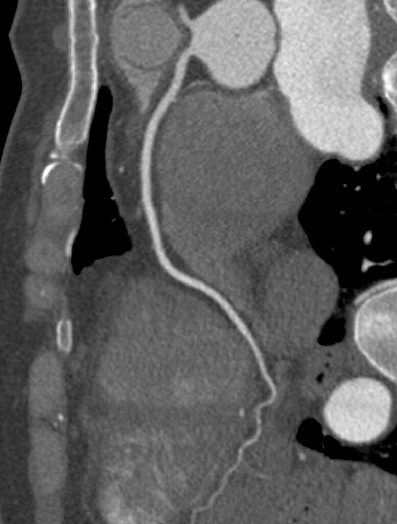 CTA Coronary artery with right coronary artery trace. | Heart and ...