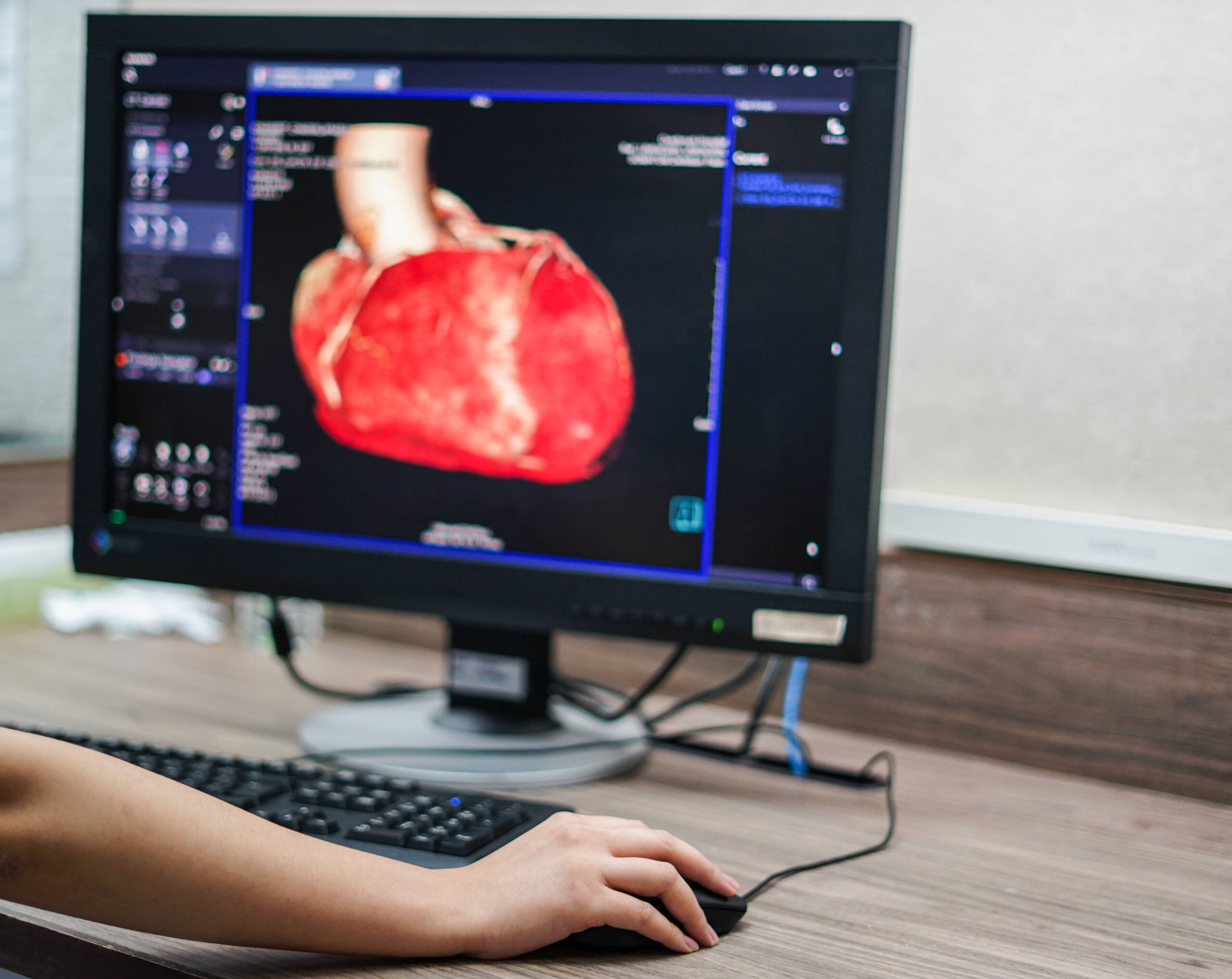 Hand holding mouse with blur Computed Tomography Angiography Coronay ...
