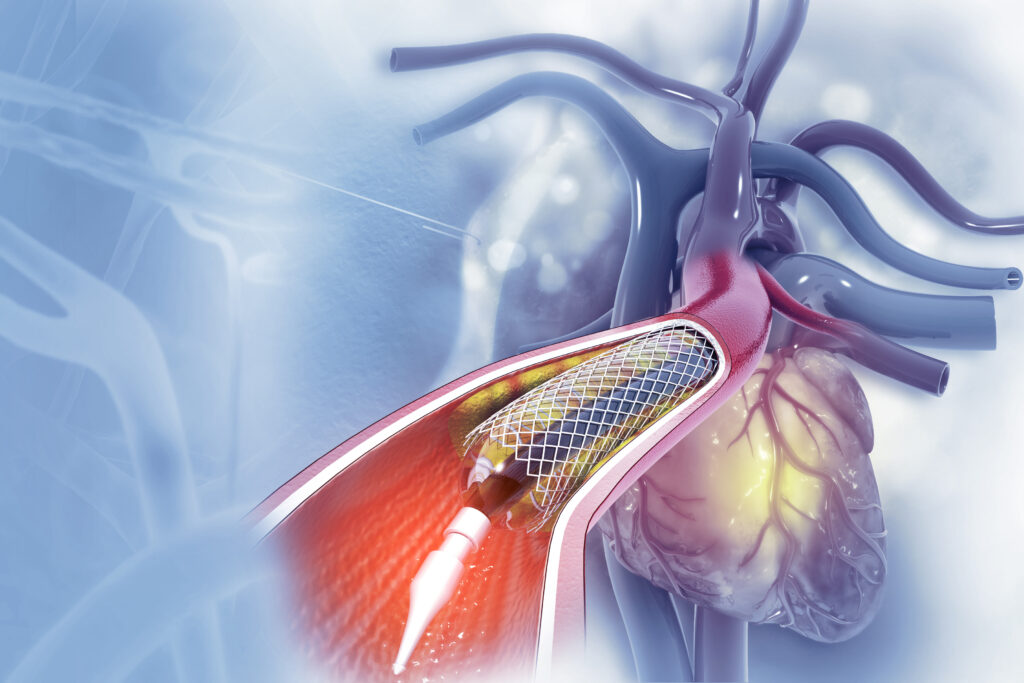 Angioplasty and Stenting