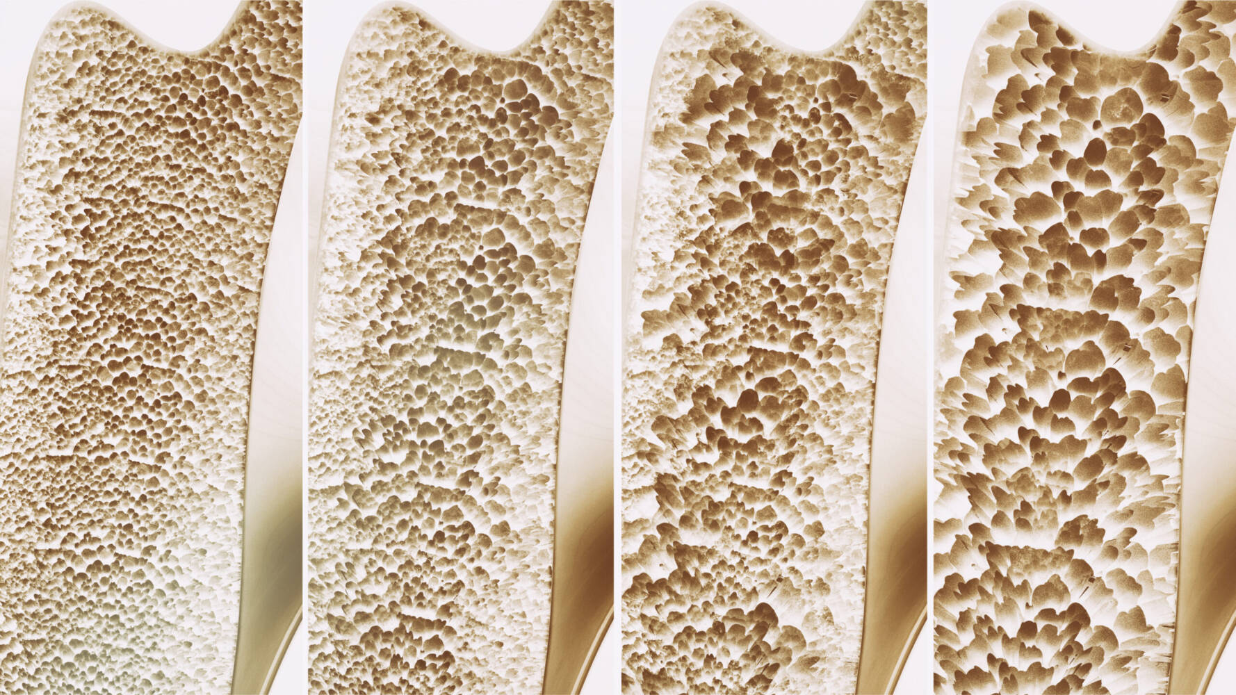 The Importance of Regular Bone Density Tests