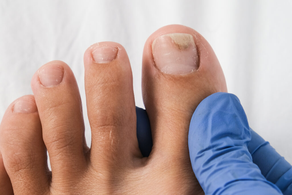 Understanding and Managing Toenail Fungus
