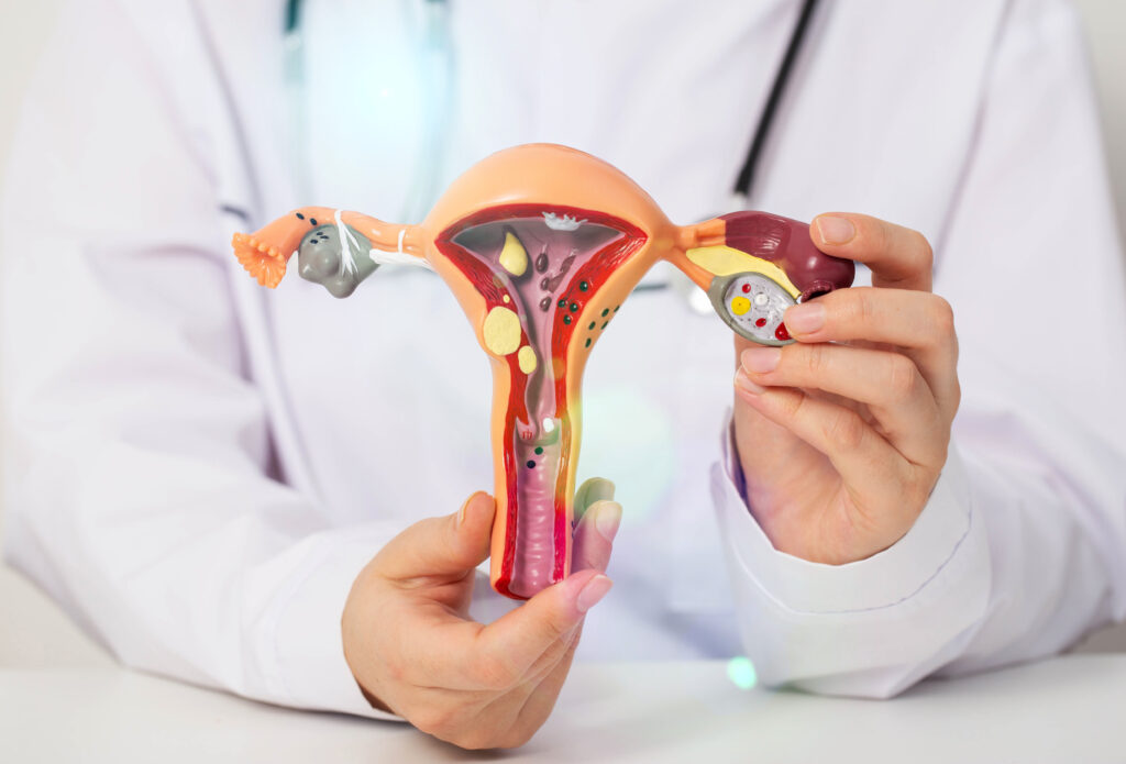 Understanding and Treating Ovarian Cysts Understanding and Treating Ovarian Cysts