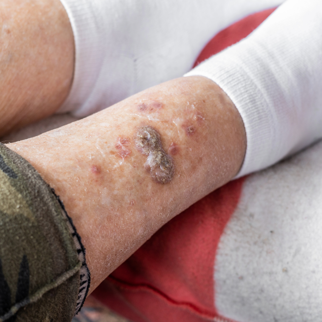 Acute vs. Chronic Wounds