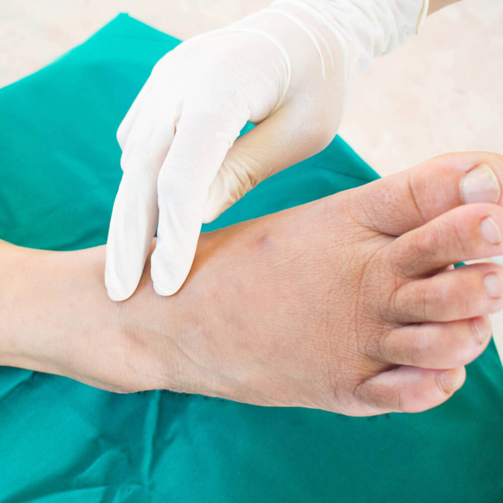 Charcot Foot in Diabetes Symptoms Causes and Treatment Guide