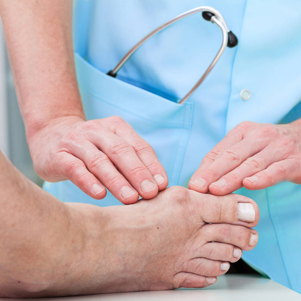 Minimally Invasive Surgery for Hallux Valgus Techniques Guide